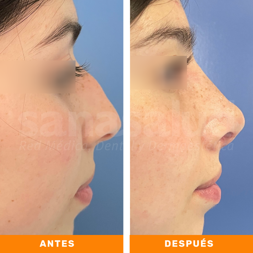 Rinoplastía - Centro Médico Sanasalud