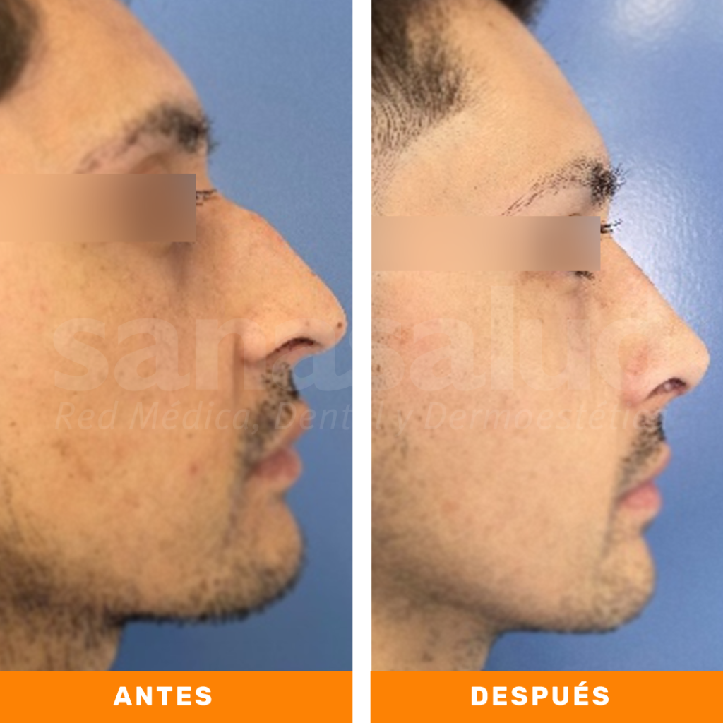 Rinoplastía - Centro Médico Sanasalud